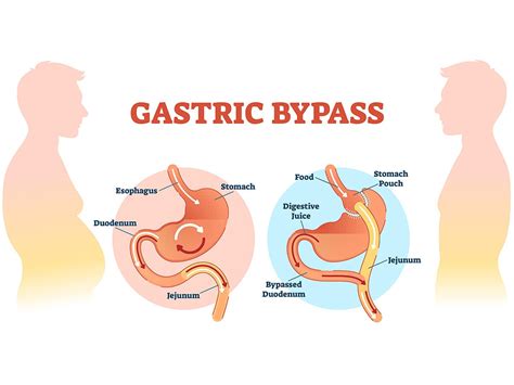 Understanding Laparoscopic Gastric Bypass Benefits And Recovery