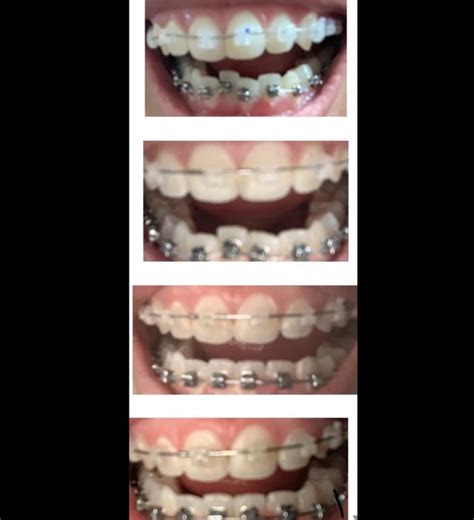 Damon Braces 4 Months R Braces