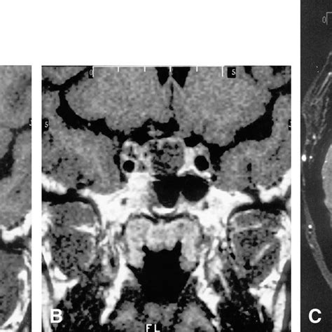 Nodular Amyloid Deposits Are Shown As Lobulated Masses Of Eosinophilic