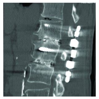 Ct Scan At 1 Year Fu Showing Solid Fusion Download Scientific Diagram