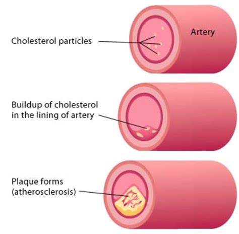 How Can I Reduce My Cholesterol Without Taking Medication HubPages