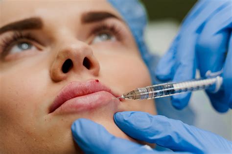 Lip Filler Complications Symptoms Of Lip Necrosis After Filler Injections