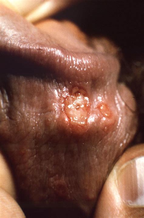 Male Genital Herpes