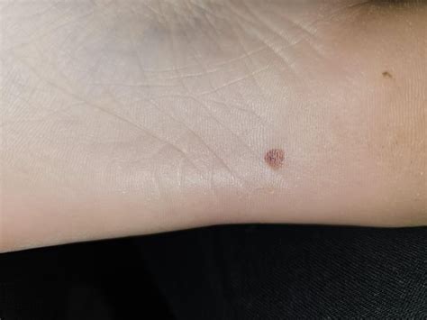Acral Lentiginous Melanoma On Sole Of Foot Rmelanoma