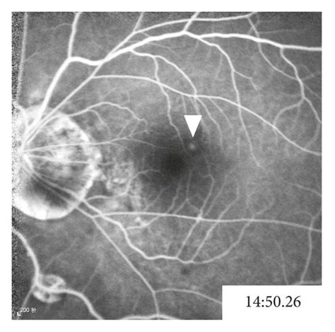 Multimodal Imaging Findings In A 49 Year Old Highly Myopic Man With