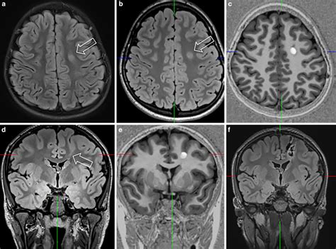 A 12 Year Old Girl Presented With Daily Sensory And Bilateral Tonic Download Scientific Diagram