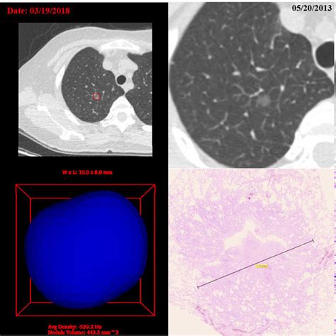 Pdf Natural History Of Pathologically Confirmed Pulmonary Subsolid Nodules With Deep Learning