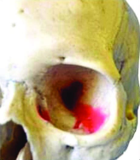 Foramina And Fissures Sealed Download Scientific Diagram