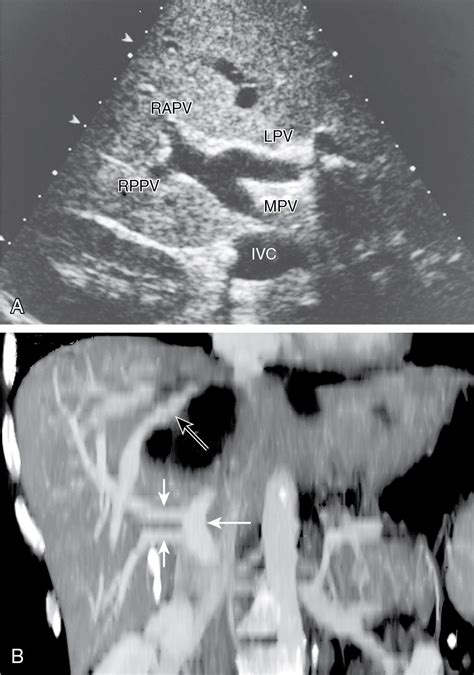 Surgical And Radiologic Anatomy Of The Liver Biliary Tract And