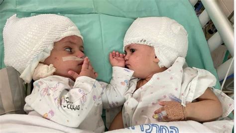 Twins Joined At The Head Are Separated After 12 Hour Surgery