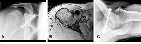 Figure 1 From Subcoracoid Impingement After The Fixation Of The