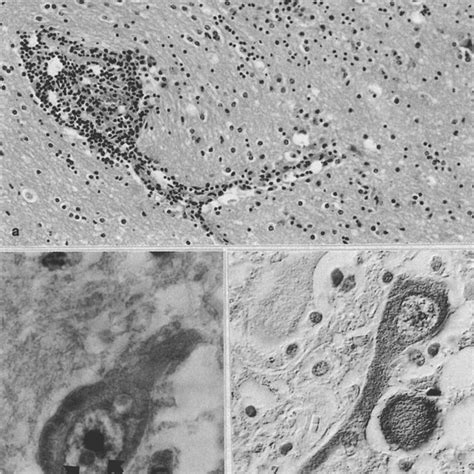 A Perivascular Cuffs And Diffuse Lymphocytic Infiltration Of Adjacent
