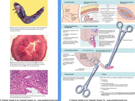 Anatomy Of Appendix PPT Digestive Disorders Diseases And Conditions