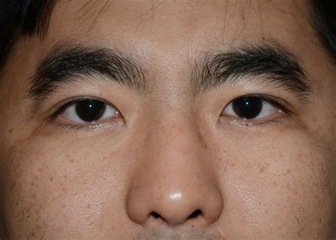 Double Eyelid 1171 Amadi Aesthetics Plastic Surgery And Med Spa
