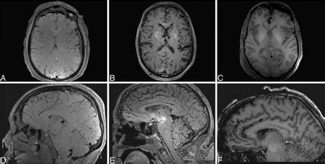 Formaldehyde Brain