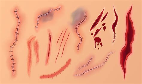 현실적인 다양한 수술 바늘 피 묻은 상처 및 흉터 흉터에 대한 스톡 벡터 아트 및 기타 이미지 흉터 바늘땀 꿰매기
