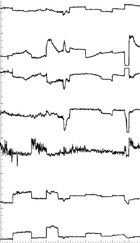 Daily Recordings Of Mean Icp Arterial Pressure Abp Cerebral