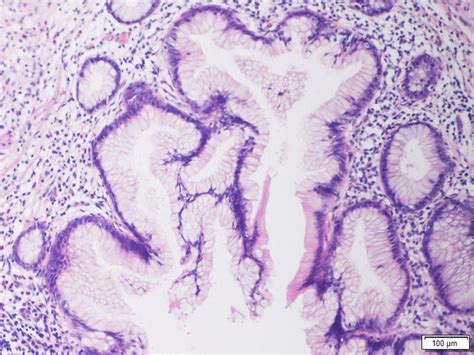 Histological Section Of A Low Grade Appendiceal Mucinous Neoplasm