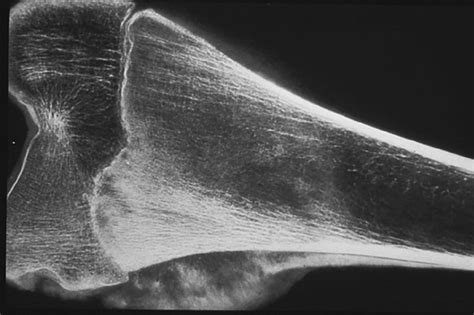 Trabecular Bone Xray