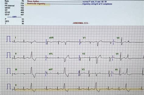 심실조기수축 의학용어 Pvc Vpc Premature Ventricular Contraction Ekg 리듬 Bigeminy Trigeminy 뜻 네이버 블로그