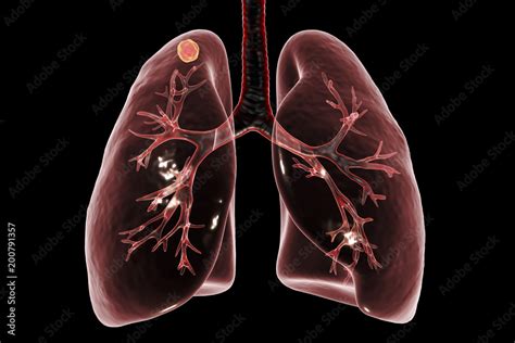 Secondary Tuberculosis In Lungs Apical Nodule 3d Illustration Stock Illustration Adobe Stock