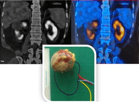 Sestamibi Scan In Small Renal Masses
