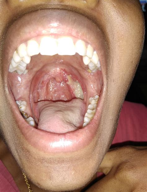 Tonsillar Fossa