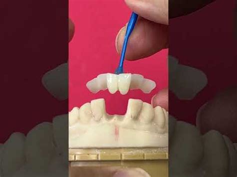 What Ada Dental Codes For A Bridge