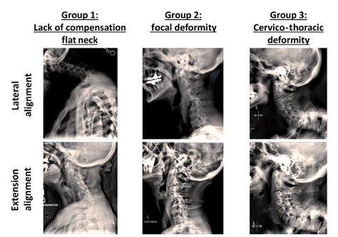 Figure 3 From Planning Cervical Deformity Surgery Including Djk Prevention Strategies Semantic