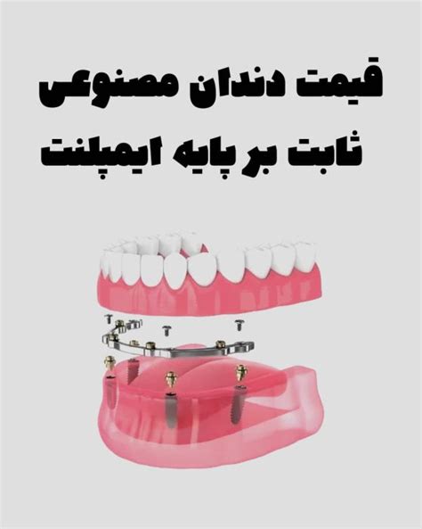 قیمت دندان مصنوعی ثابت بر پایه ایمپلنت
