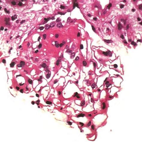 Collapsing Fsgs It Shows Podocyte Hypertrophy Download Scientific Diagram