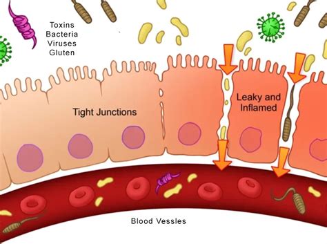 Leaky Gut Understanding The Causes Symptoms And Solutions For Better