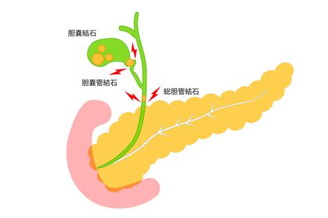胆石の症状や原因｜石川消化器内科・内視鏡クリニック