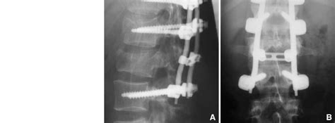 Postoperative X Ray Of The Thoracolumbar Junction After Reposition And