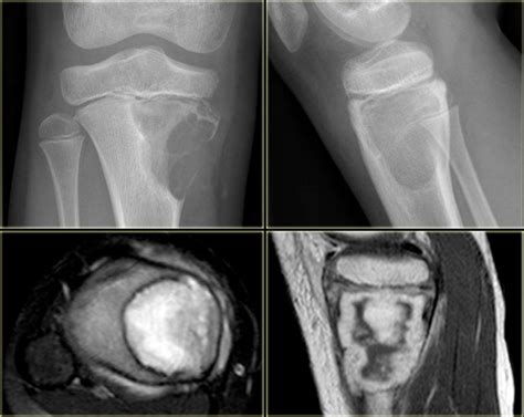 The Radiology Assistant Osteolytic Well Defined Bone Tumors