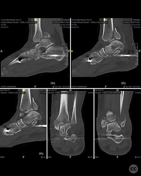 Staged Management Of Osteomyelitis Following Open Tibial Pilon Fracture