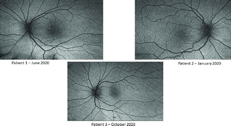 Patient 1 Yellowish Hue Within The Macula With Loss Of Fovea Reflex Download Scientific
