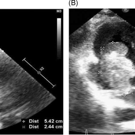 Transthoracic Echocardiography A Apical Four‐chamber View And B