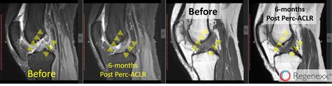 Healing Another Acl Tear With A Precise Injection Of Stem Cells Stemsurg®