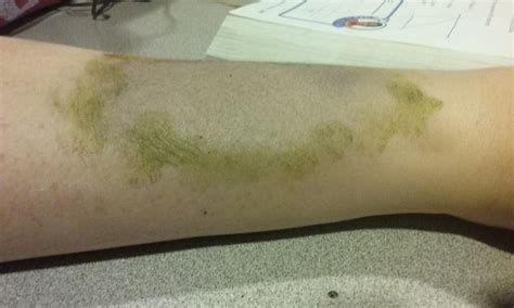 Special Effects Makeup Bruise At James Ivery Blog