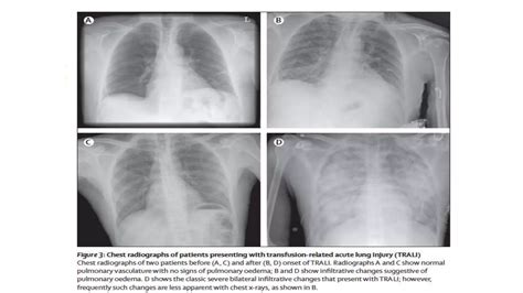 LESION PULMONAR AGUDA Pptx