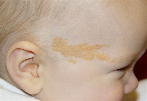 Histopathology Of Nevus Sebaceous Reveals Acanthosis