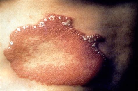 Ringworm  Naked Scientists