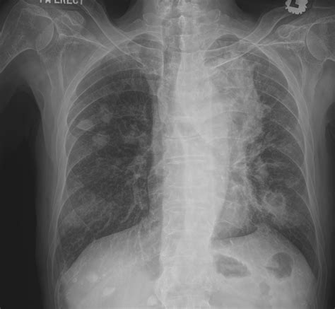 Likely Primary Lung Carcinoma Uni Clinic