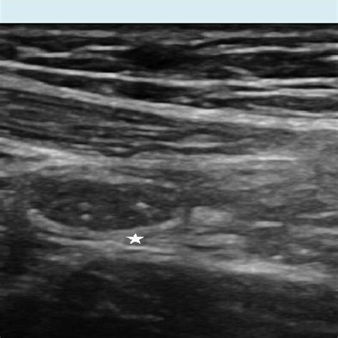 Ileal Ultrasound Ileal Loop With Normal Echogenicity Of Submucosa Star Download Scientific