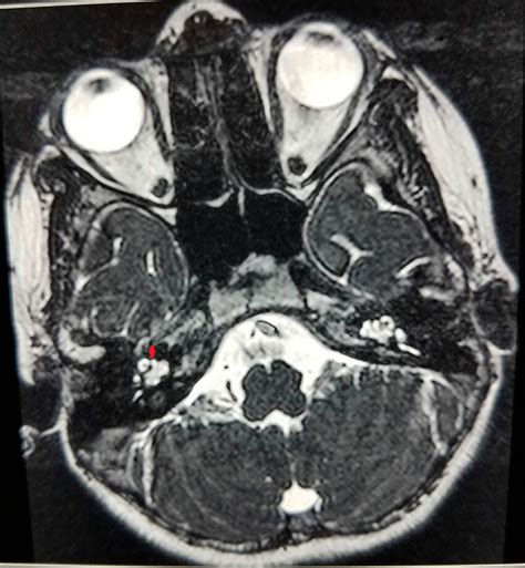 T2 Mri Demonstrating A Fluid Filled Cochlea Download Scientific Diagram