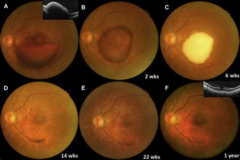 Natural Course Of Ruptured Retinal Arterial Macroaneurysm Ophthalmology Retina