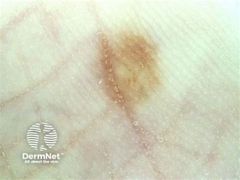 Dermoscopy Benign Melanocytic Lesions