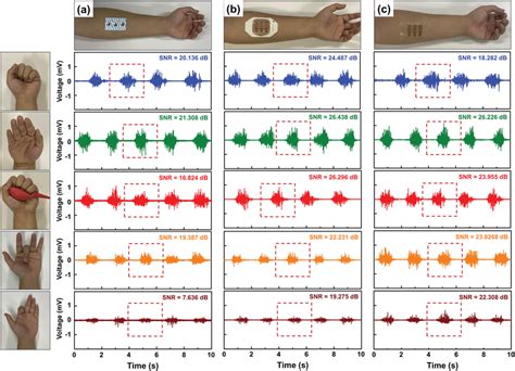 Application Of The E‐jet‐printed Metal Microelectrodes In Emg Signal Download Scientific