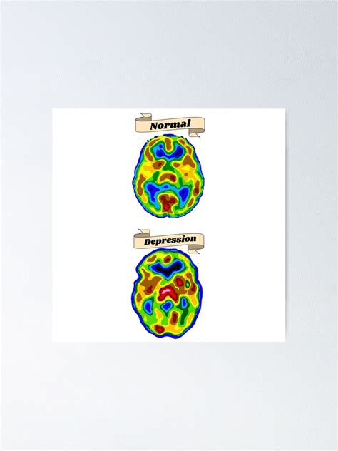 Normal Vs Depressed Brain Scan Poster For Sale By Xlesserpandax